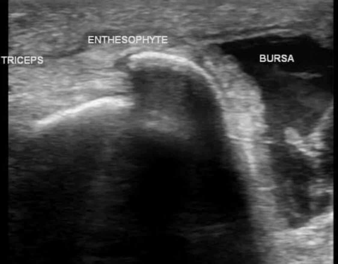 Olecranon Bursitis