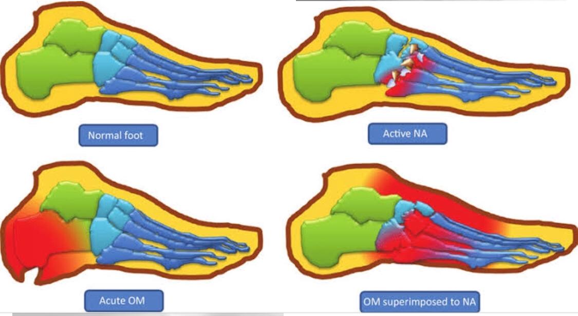 Osteomyelitis in Diabetic Foot